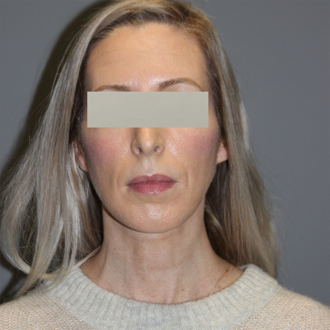 Genioplasty Gallery - Dr. Lee B. Daniel